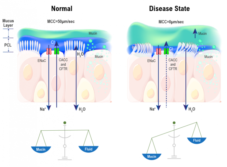 About Muco – Obstructive Lung (Pulmonary) Diseases | splisense.com
